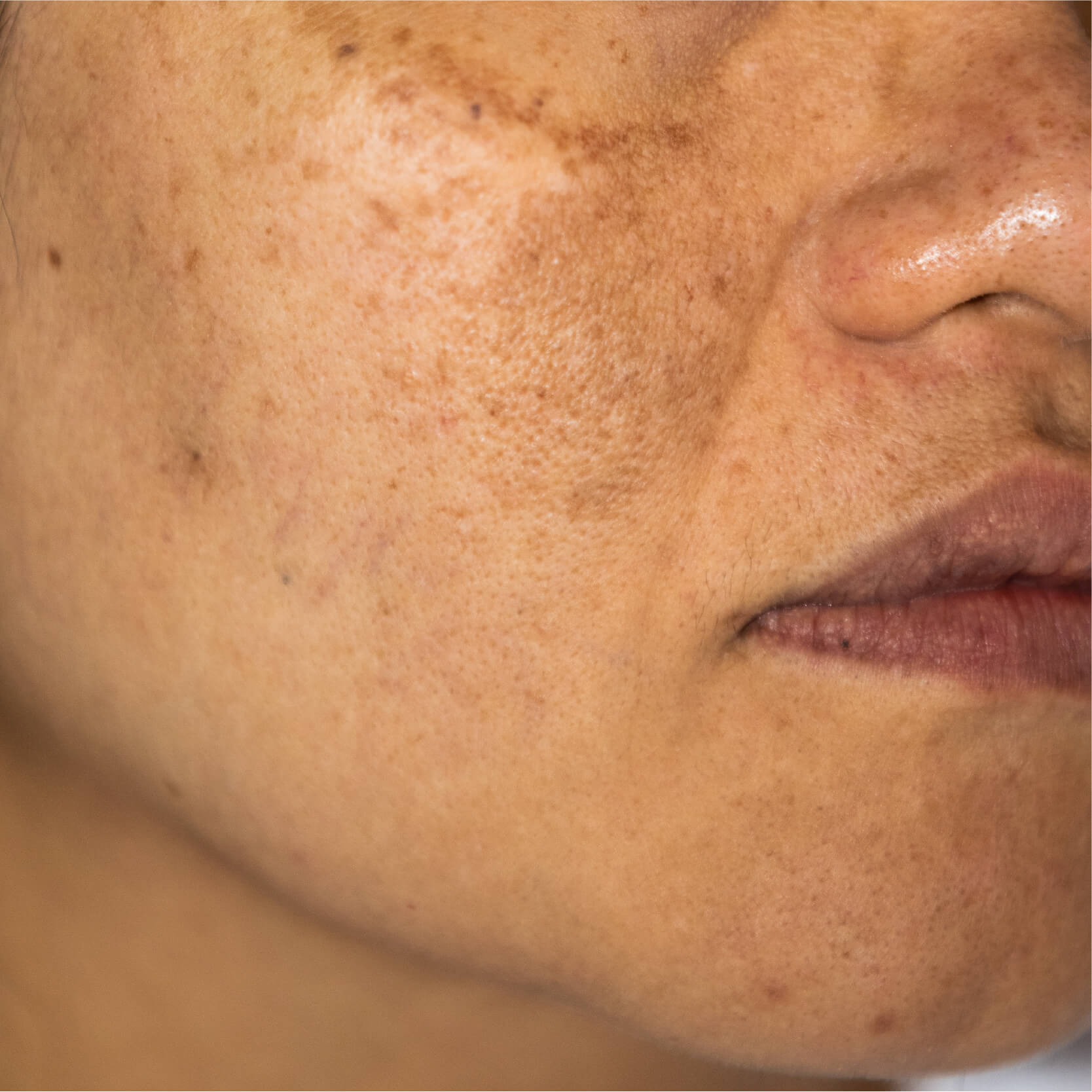 Skincare for Hyperpigmented Skin – The A Method®