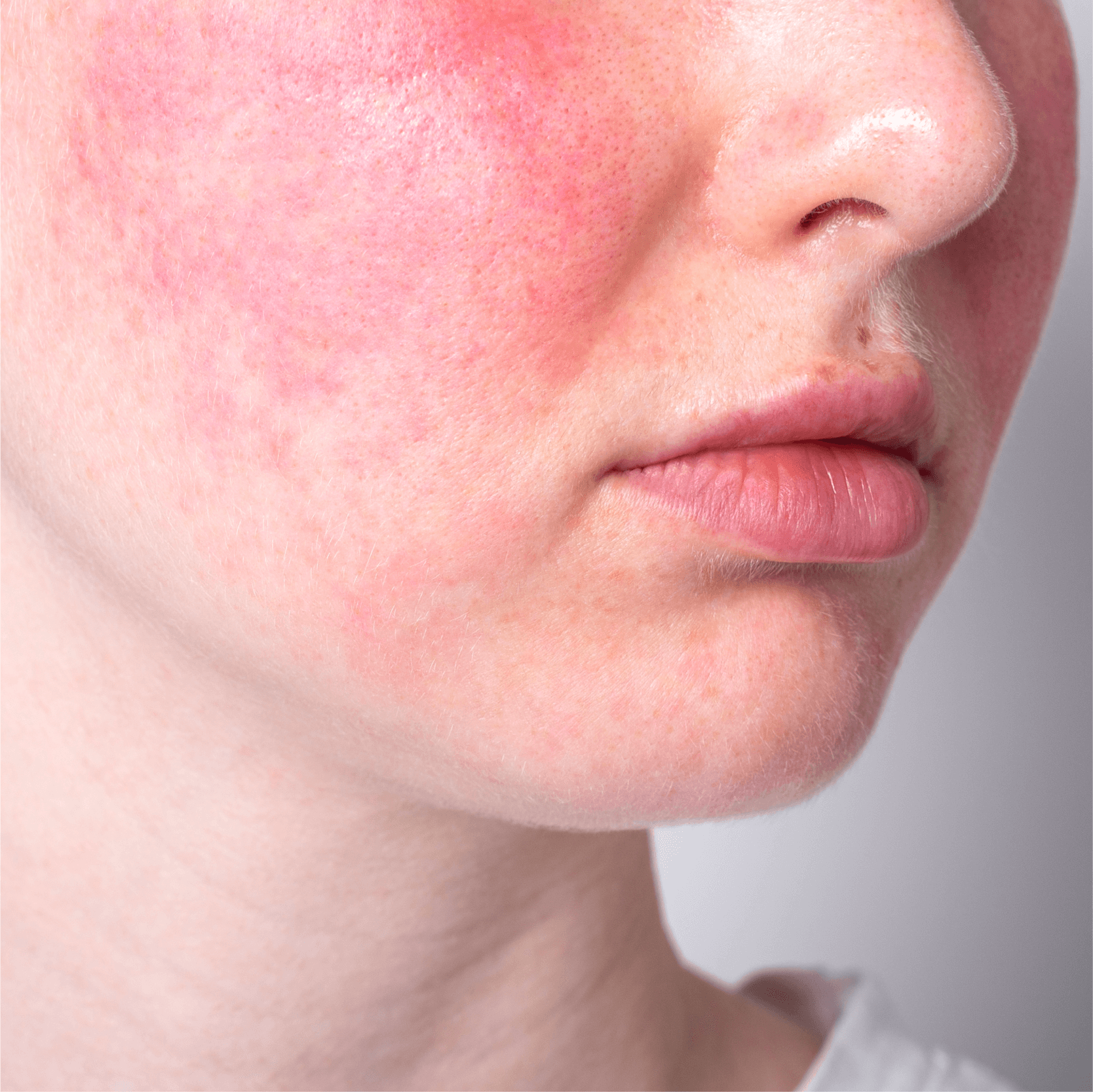 Redness Relief Skincare – The A Method®